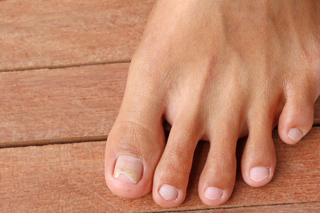 Unha preta suja: Causas e Dicas de Cuidados - Portal Zoe