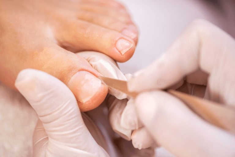 Manchas Esbranquiçadas nas Unhas: Causas e Soluções - Portal Zoe